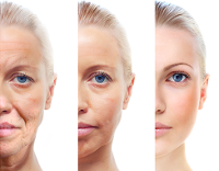 Remodelare faciala cu acid hialuronic