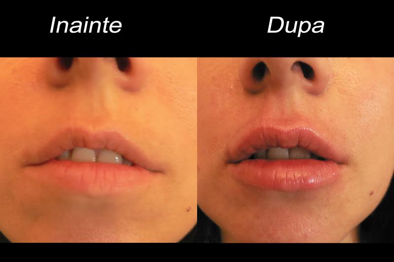 Remodelare faciala cu acid hyaluronic/botox - Clinica SlimArt